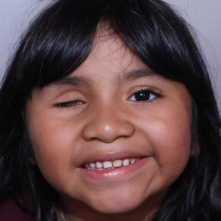 Prosthetic Eye Patient Photos | Carolina Eye Prosthetics