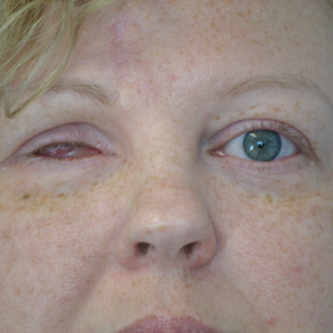 Prosthetic Eye Patient Photos - Carolina Eye Prosthetics