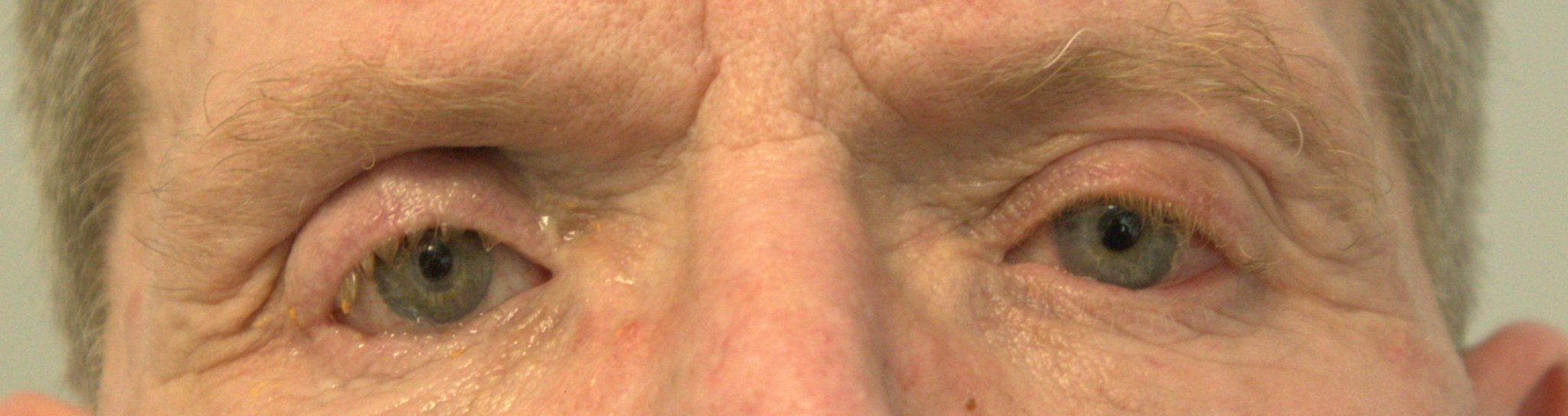 What Do Prosthetic Eyes Look Like? | Carolina Eye Prosthetics