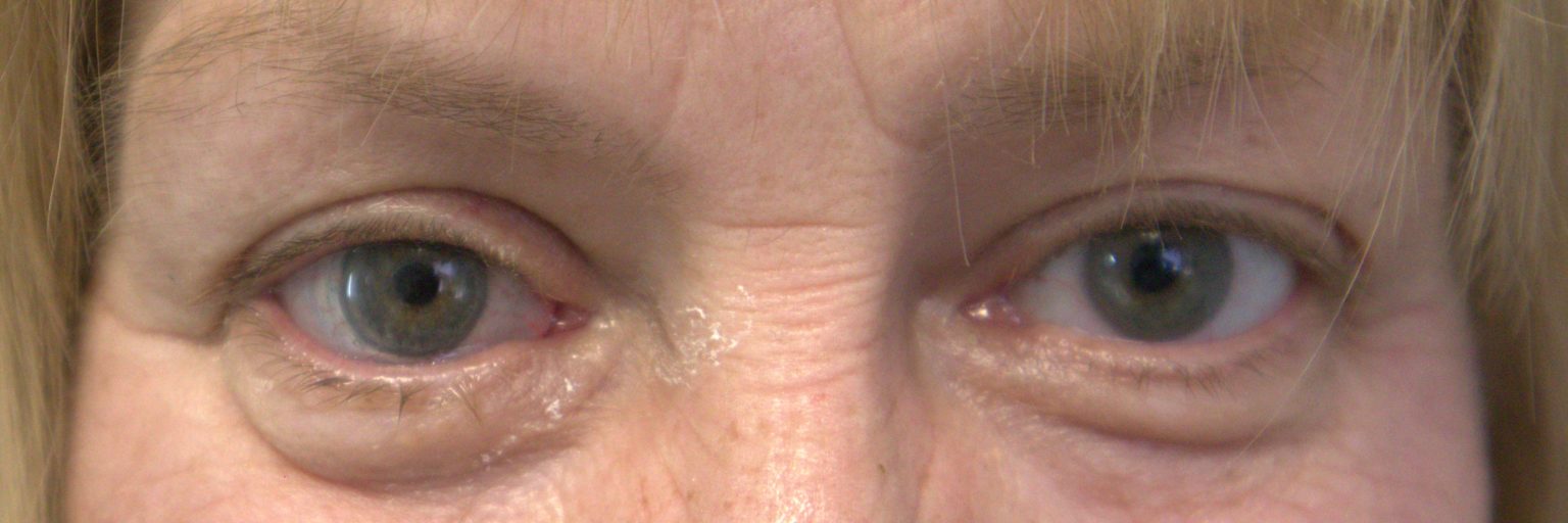 Eye Loss: What Does It Look Like? | Carolina Eye Prosthetics