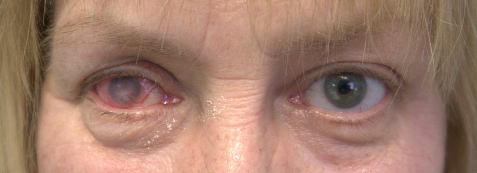 Eye Loss: What Does It Look Like? | Carolina Eye Prosthetics