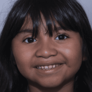 What Do Prosthetic Eyes Look Like? | Carolina Eye Prosthetics