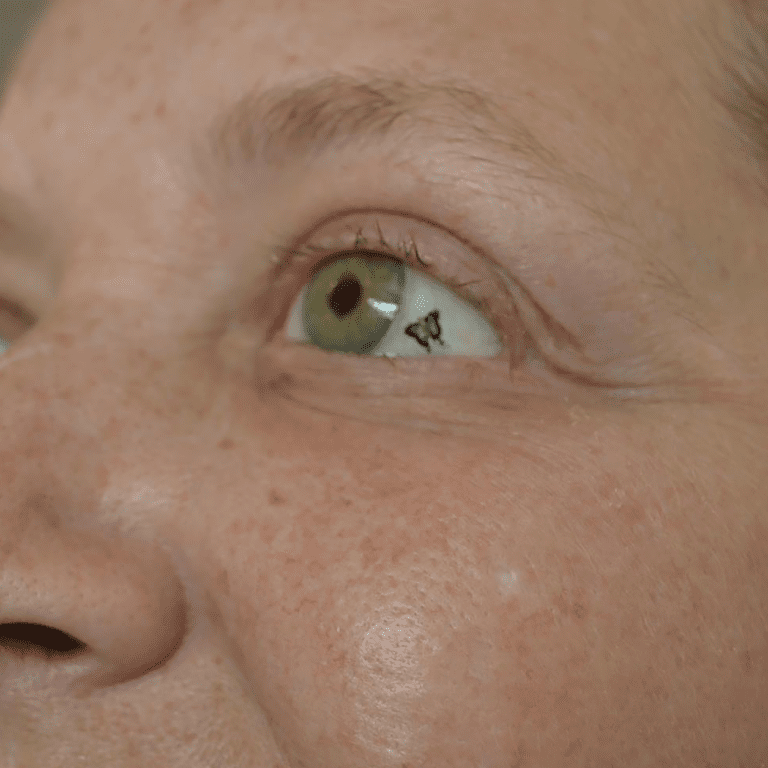 Prosthetic Eye Patient Photos | Carolina Eye Prosthetics